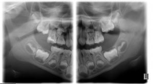 Radiografía Bite Wing Extraoral – Ray Dent